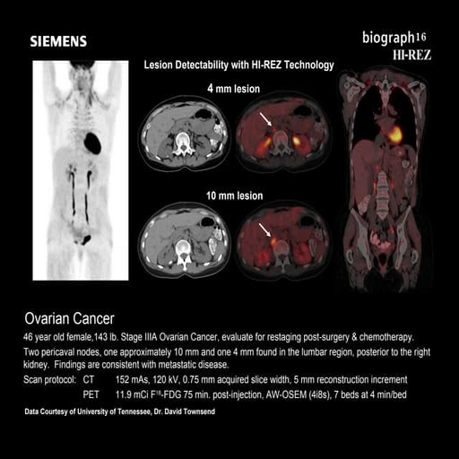 Ovarian | PPT