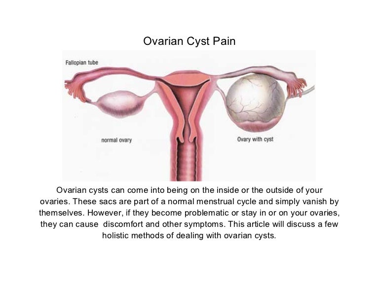 Ovarian Cyst Pain 20121224 ovarian-cyst-pain-20121224