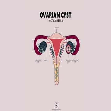 Ovarian Cyst | PPTX