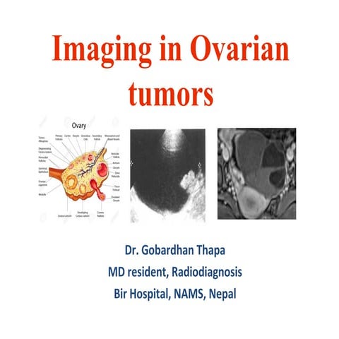Ovarian Tumors Ppt
