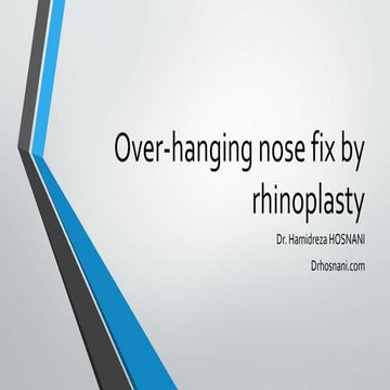 Over -hanging nose fix by rhinoplasty | PPTX
