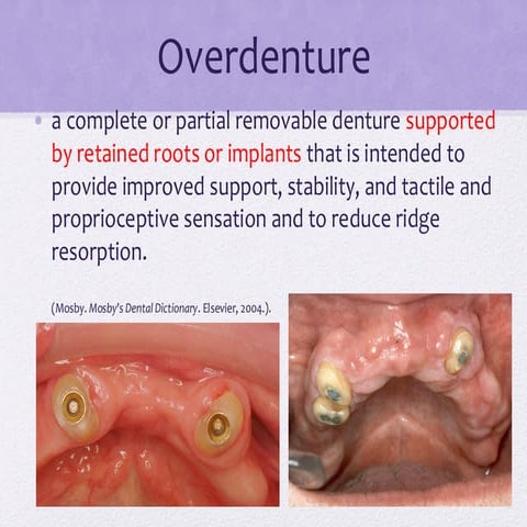 overdenture cpd.pdf prosthodontics………….. | PDF