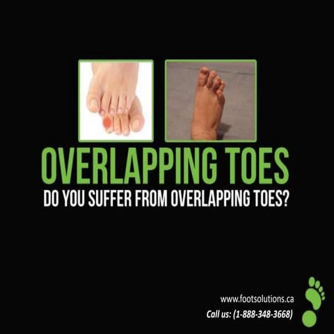 Overlapping toes | PPTX