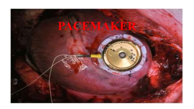 Pacemaker powerpoint presentation med surg | PPTX | Heart and ...