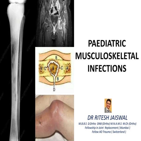 Paediatric musculoskeletal infections | PPTX