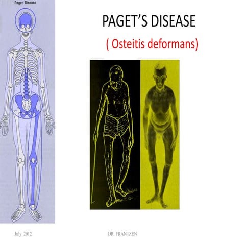 Paget disease .ppt