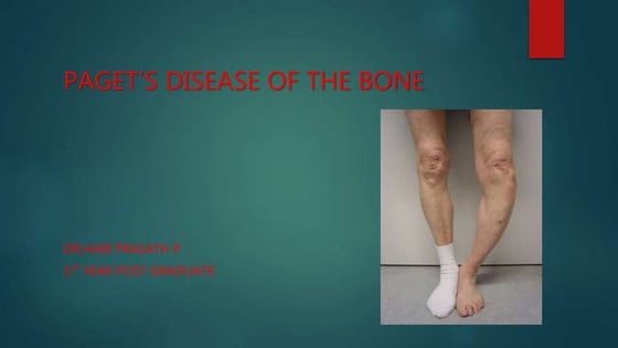 Pagets disease | PPT | Bone and Joint Conditions | Diseases and Conditions