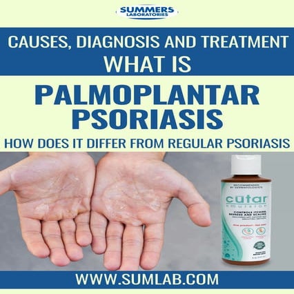 What is the new treatment for palmoplantar psoriasis? | PDF