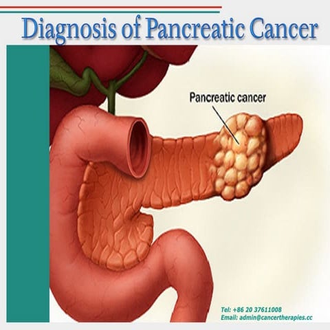 Diagnosis of Pancreatic Cancer | ODP