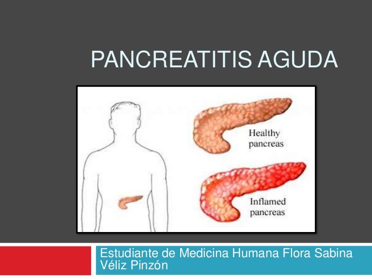 Pancreatitis Aguda