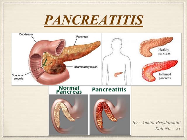 Pancreatitis (acute and chronic )