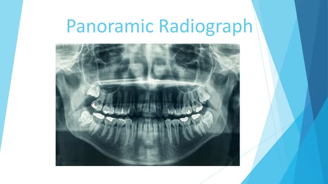 Maxillary denture-landmarks | PPTX