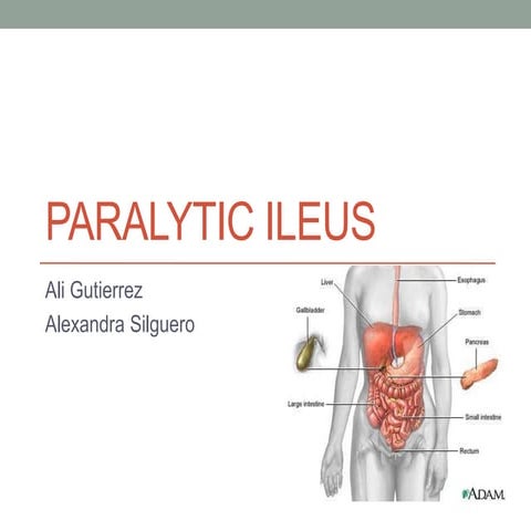 Paralytic ileus | PPT