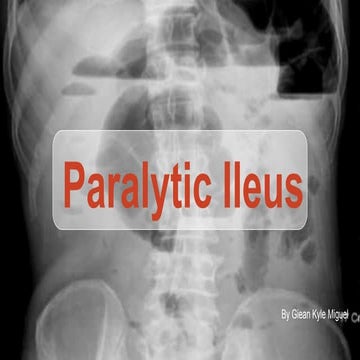 Paralytic ileus | PPTX