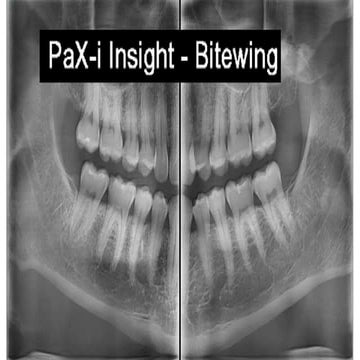 Radiographicity interpretations of iopar | PPTX