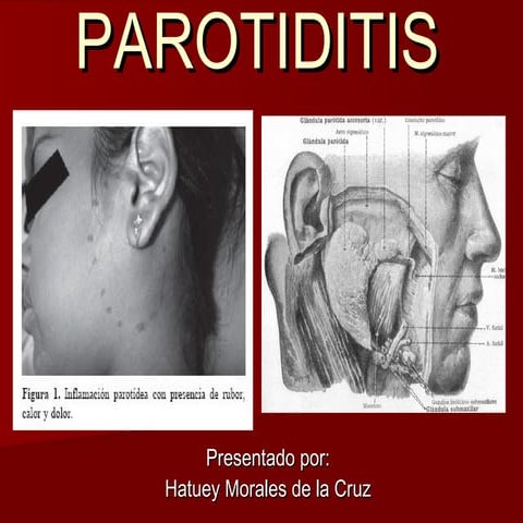 Parotiditis | PPT