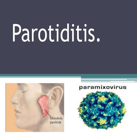 Parotiditis | PPTX