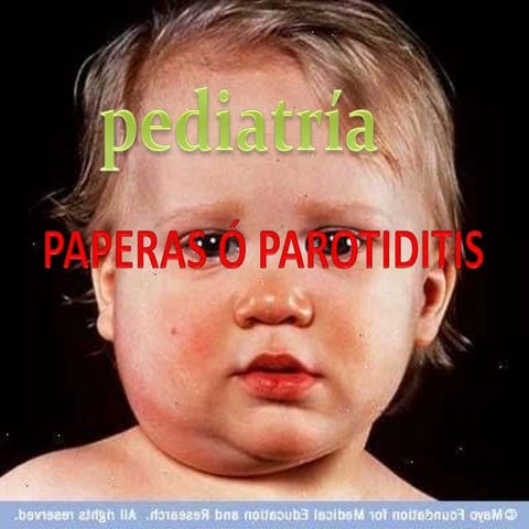 Parotiditis EN PEDIATRIA | PPT