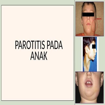 Parotitis epidemika, gondongan mumps in pediatric | PPT