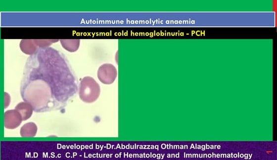 Warm and cold autoimmune hemolytic anemia | PPT