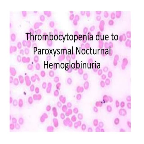 Paroxysmal Nocturnal Hemoglobinuria Blood Smear