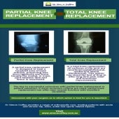 Partial Knee Replacement VS Total Knee Replacement