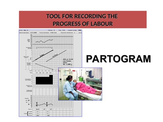 Partogram | PPT | Pregnancy | Reproductive Health