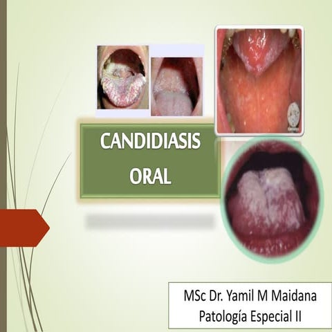 candidiasis oral | PPTX