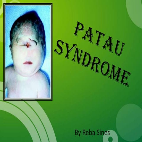 Patau Syndrome | PPTX