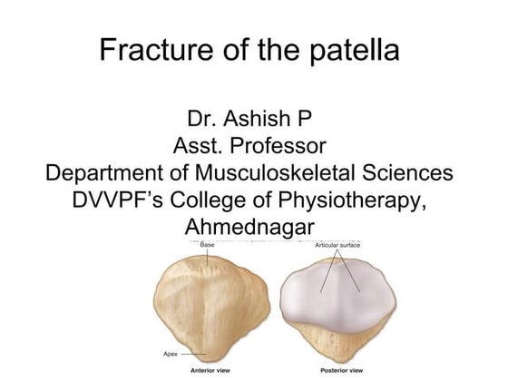 Distal End Radius Fractures - Colles, Smiths & Bartons | PPT
