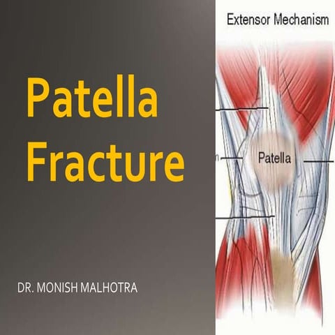 Patella fracture | PPTX