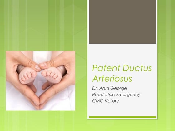 Patent Ductus Arteriosus | PDF