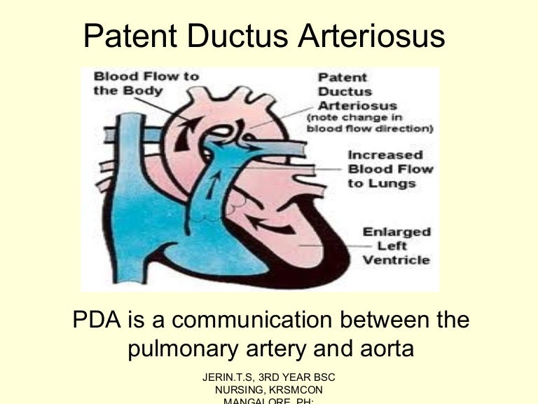 Patent ductus arteriosus