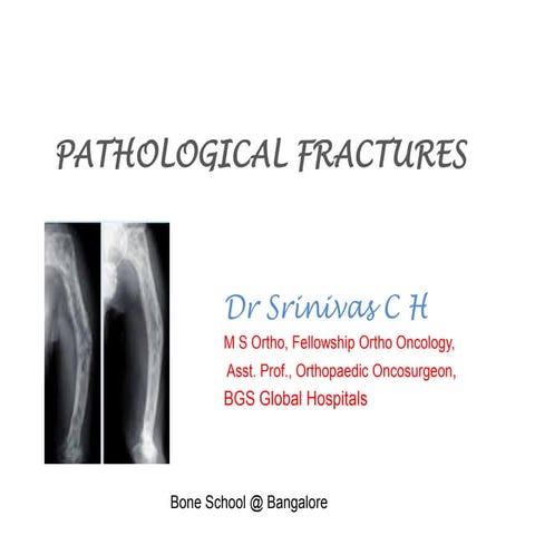 pathological fractures are the one of the important topics asked in ...