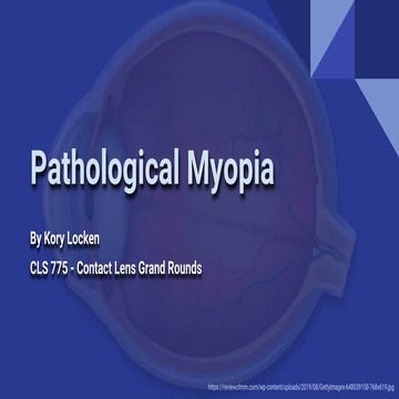 Pathological Myopia and how it can effect CL Rx | PPT