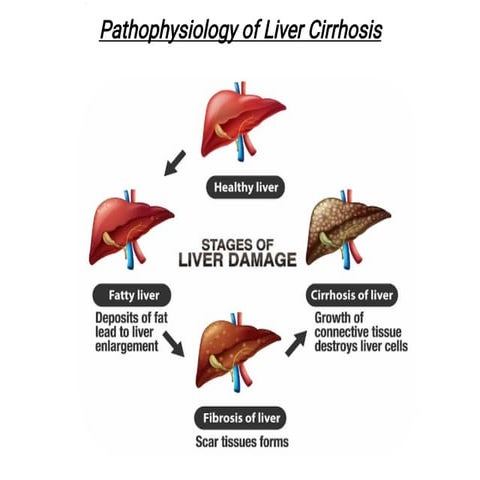 pathophysiology liver cirrhosis persention.pdf