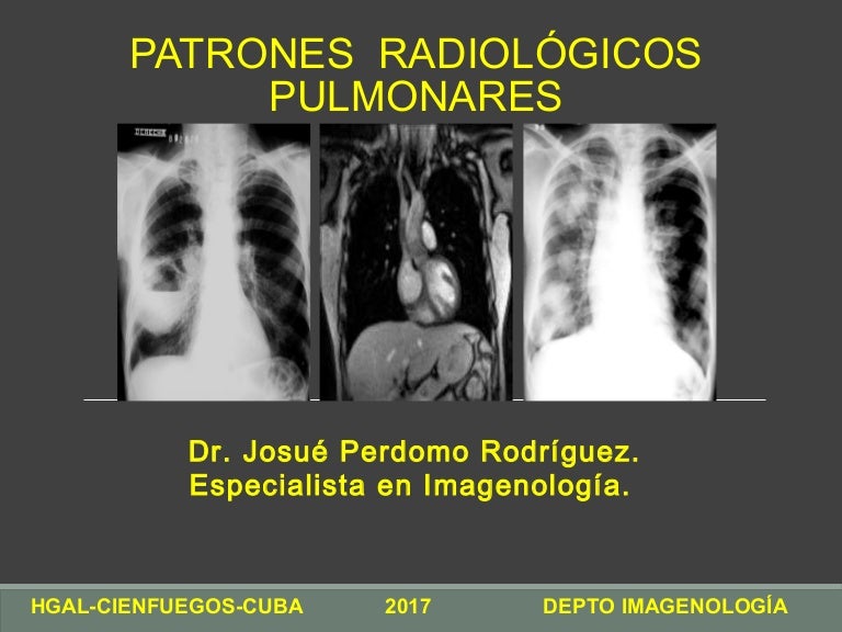 Patrones radiológicos pulmonares