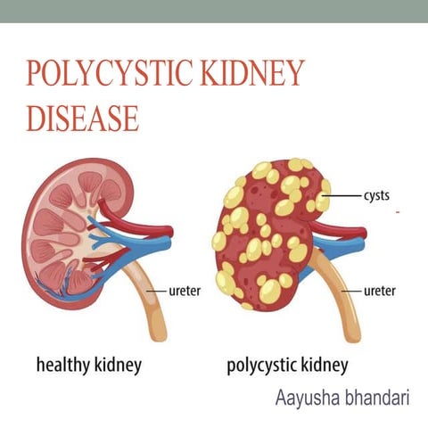 Polycystic kidney disease | PPTX