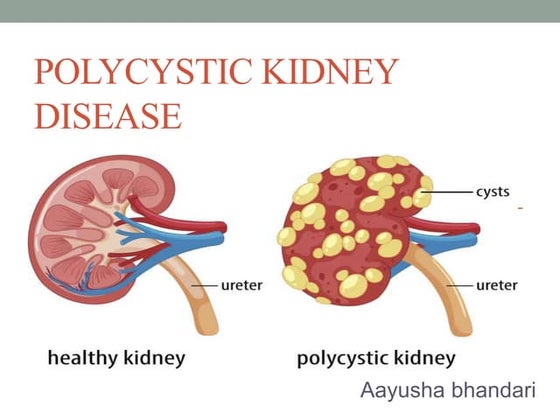 Polycystic Kidney Disease final.pptx