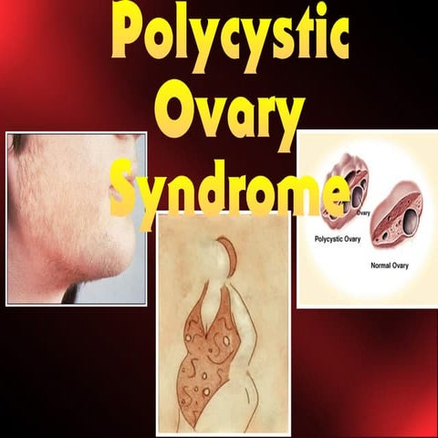 Pcos | PPT | Hormonal Disorders | Endocrine and Metabolic Diseases