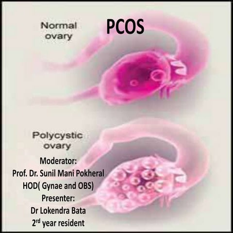 Polycystic Ovary Syndrome (PCOS) | PDF