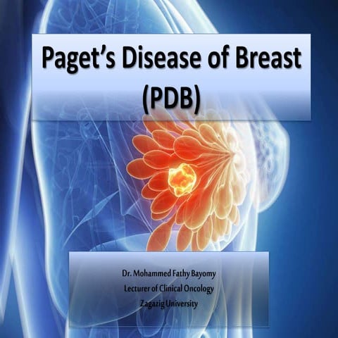 Paget’s Disease of Breast (PDB) | PPTX