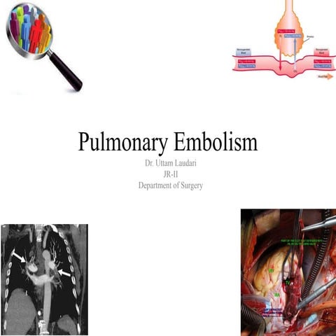 Pulmonary embolism | PPTX