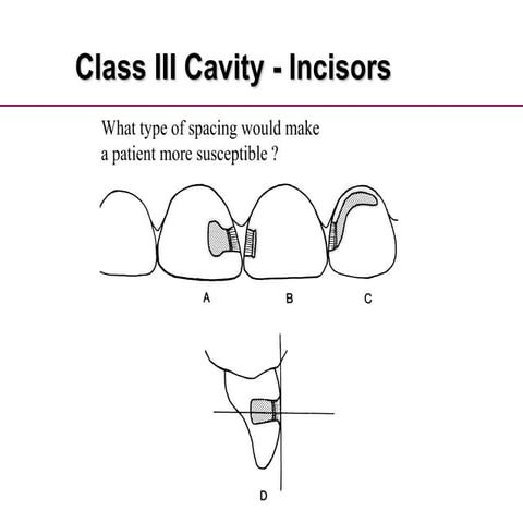 Class III cavity preparation | PPTX