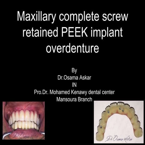 Peek implant supported screw retained maxillary complete overdenture | PPTX