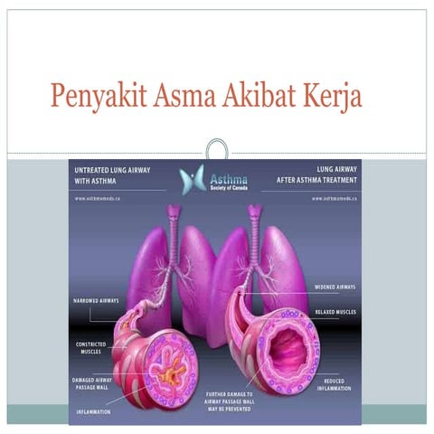 Penyakit-asma-akibat-kerja.pptx