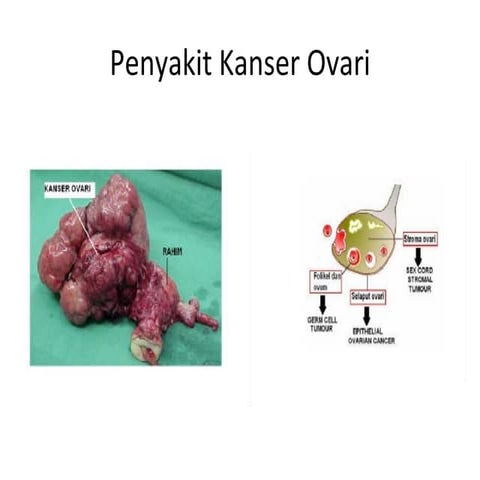 Penyakit kanser ovari | PPT