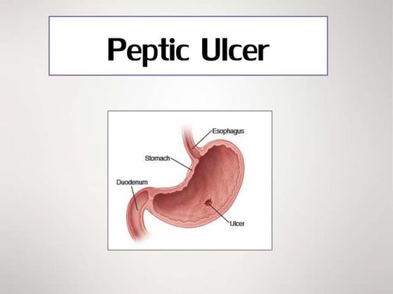 Peptic ulcer | PPT