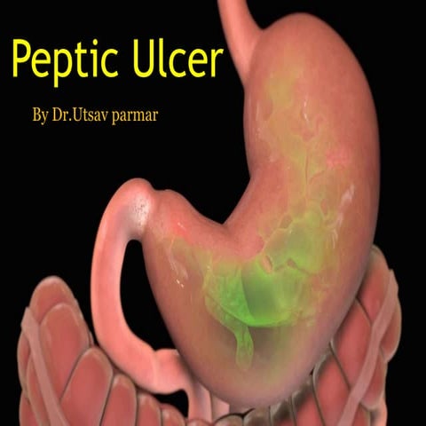 Peptic ulcer | PPTX