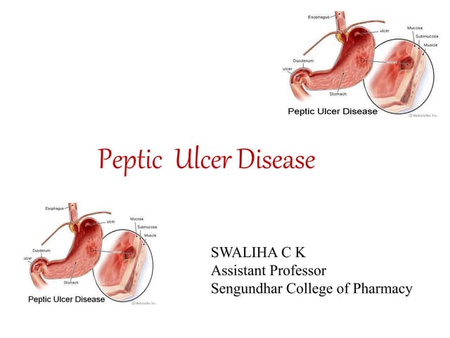Peptic ulcer disease | PPT